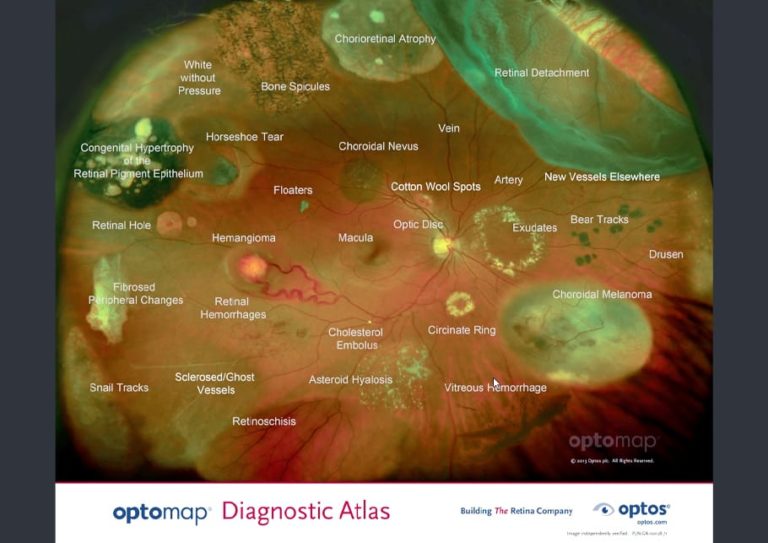 Optomap Retinal Imaging | Winnipeg | See Eye Clinic